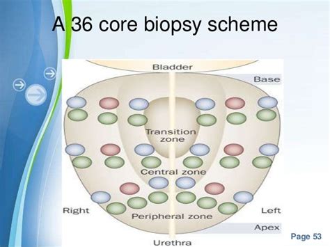 Trus Biopsy Prostate