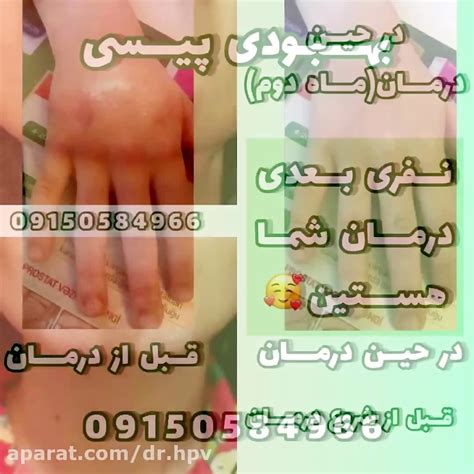 درمان پیسی ویتیلیگو گیاهی