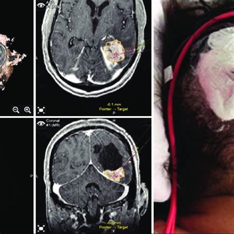 Intraoperative Neuronavigation Brainlab ® Munich Germany Download Scientific Diagram