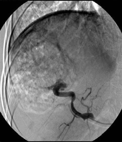 Transarterial Embolisation Of A Large Focal Nodular Hyperplasia Using