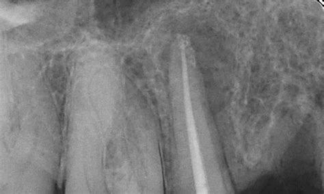 Emergency Root Canal Upper Premolar And Extraction Infected Retained