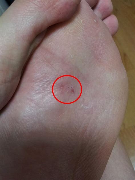 뽐뿌 발바닥에 조그만 구멍이 송송 생기네요 아시는분 계신가요