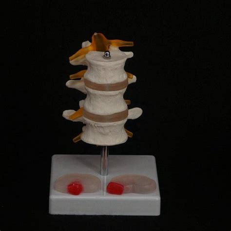 Human Three Lumbar Lesions Intervertebral Disc Skeleton Spine Medical
