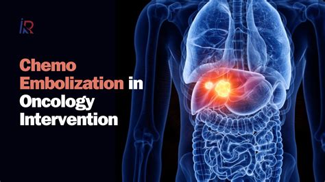 Chemoembolization In Oncology Intervention