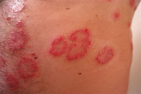 Almirall lanza en España Skilarence para psoriasis en placas DiarioMedico