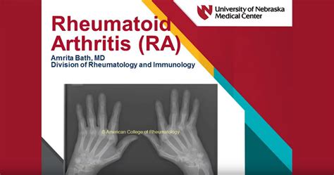 Rheumatoid Arthritis Nebraska Medicine Omaha Ne