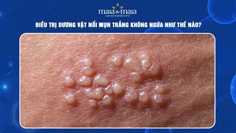 Điều Trị Dương Vật Nổi Mụn Trắng Không Ngứa Như Thế Nào