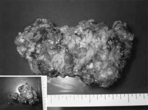 Figure 4 From A Case Of Pseudomyxoma Peritonei Diagnosed Concomitant