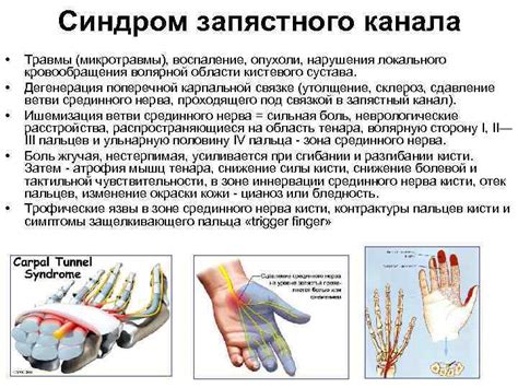 Запястный синдром симптомы