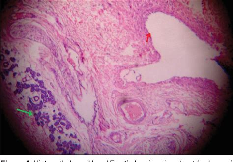 Figure 4 From A Type Ii First Branchial Cleft Anomaly Presenting As A