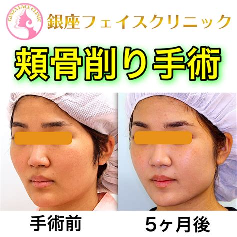 頬骨削りの症例写真 小顔整形・輪郭整形専門の美容外科 銀座フェイスクリニック