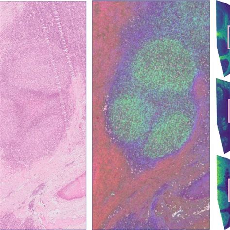 Left Hande Stained Microscopy Image Of Neighboring Lymph Node Tissue Download Scientific