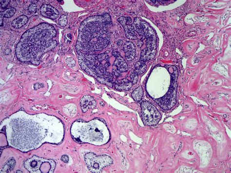 Practical Review Of Ovarian Sex Cordstromal Tumors Surgical