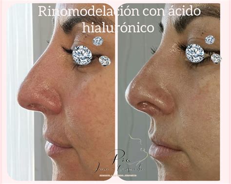 Rinomodelación Con Ácido Hialurónico Pia Jaraquemada