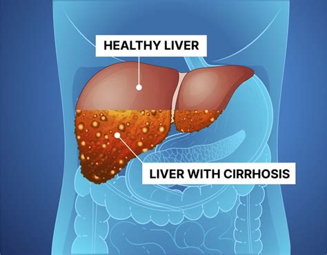 Liver Cirrhosis Causes Symptoms And Treatment Pratidin Tv