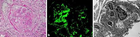 Renal Biopsy Specimen A Light Microscopy Showed Cellular Crescent