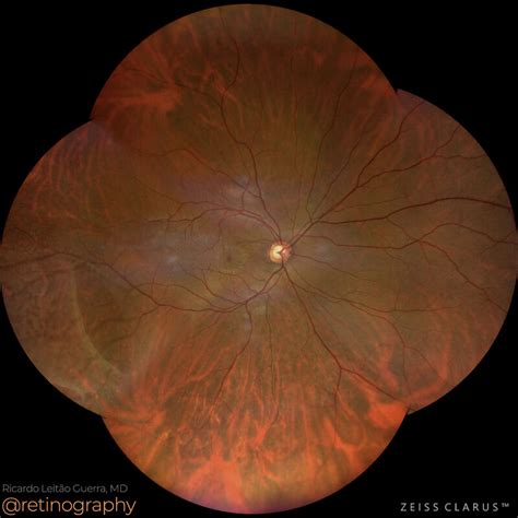Retinography Sharing And Learning On Linkedin Degenerative Retinoschisis And Retinal Detachment