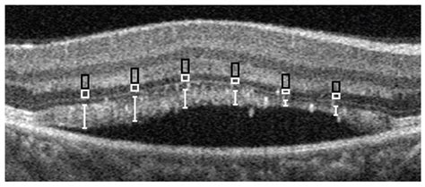 Measurement Of Outer Nuclear Layer Outer Plexiform Layer Complex And Download Scientific