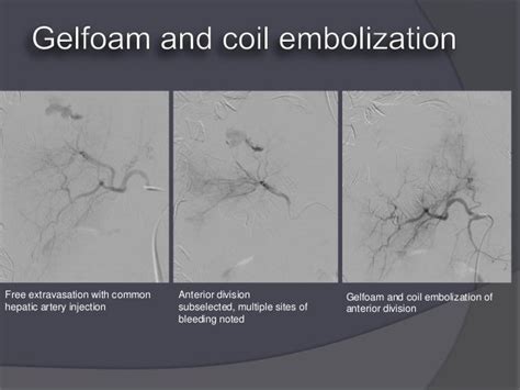 Life Saving Embolizations