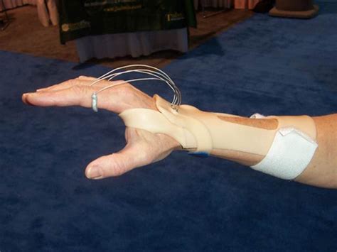 Tendon Transfers Musculoskeletal Key