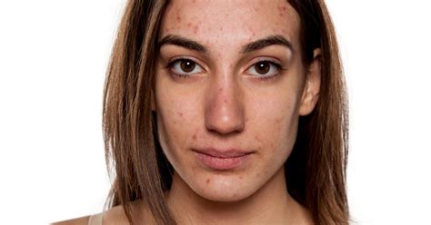 Kleine Pickel Im Gesicht Ursachen And 8 Tipps