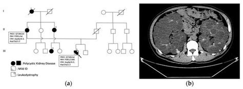 Triple Genetic Diagnosis In A Patient With Late Onset Leukodystrophy