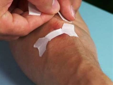 How To Use A Butterfly Bandage For First Aid American Patriot Survivalist