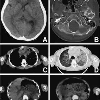 Computed Tomography Scans Of The Head A B Chest C D And Abdomen