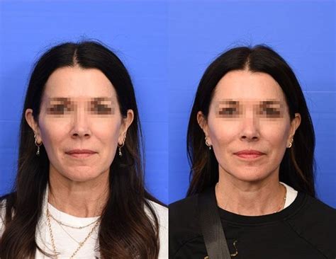 Face Lift — Sky Facial Plastic Surgery
