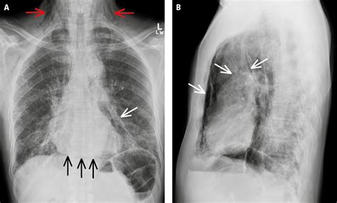 Differential Diagnosis Of Pneumomediastinum At Stephanie Trumble Blog