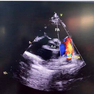 Short Axis Echocardiography View The Image Shows A PDA With A Diameter Download Scientific