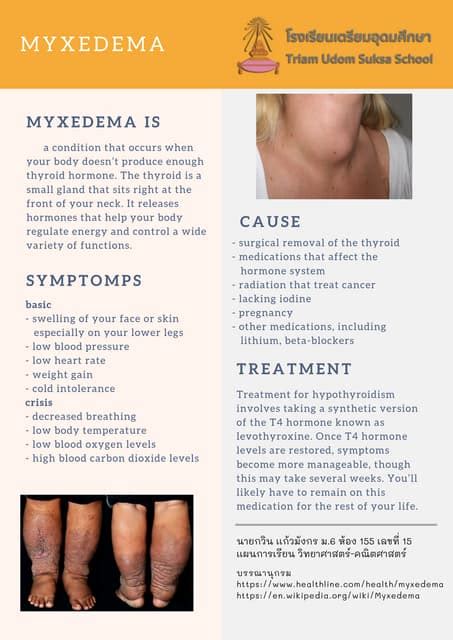 Myxedema Pdf