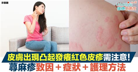 【出風癩】皮膚生紅色皮疹？蕁麻疹致因＋症狀＋治療與護理方法
