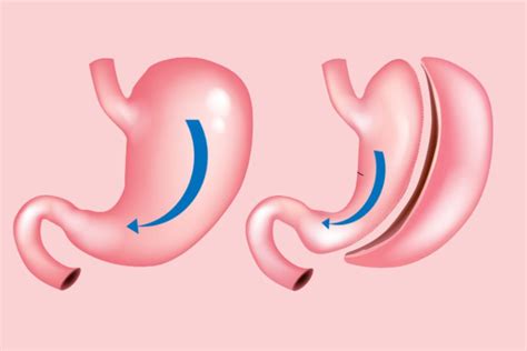 Gastric Sleeve Surgery In Tijuana Wls Clinic