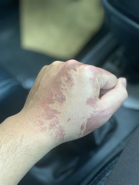 Burning Hand Stock Image Image Of Water Hands Scalded 294450125