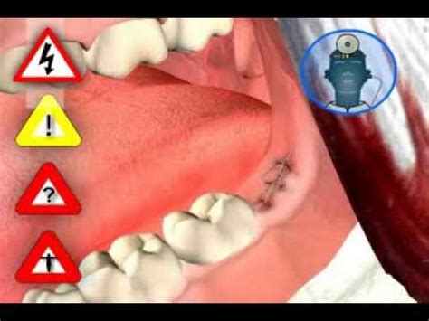 Wisdom Tooth Extraction Youtube
