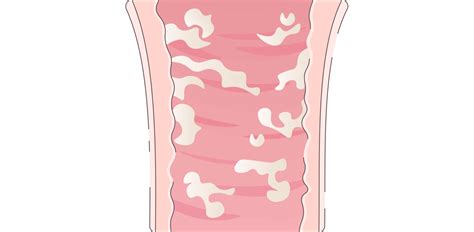 Дискомфорт в интимной зоне женщины всё о причинах