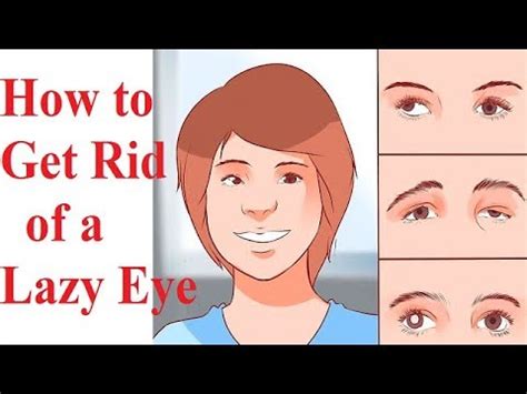 How To Get Rid Of A Lazy Eye YouTube