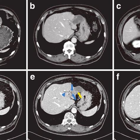 A Contrast Enhanced Ct Before Transarterial Chemoembolization Tace