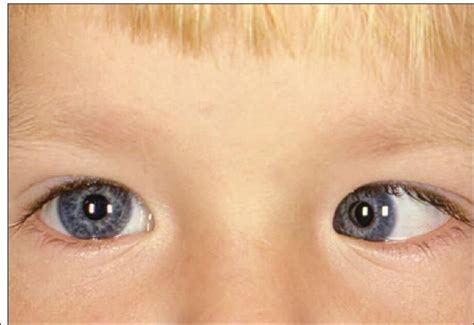 Strabismus