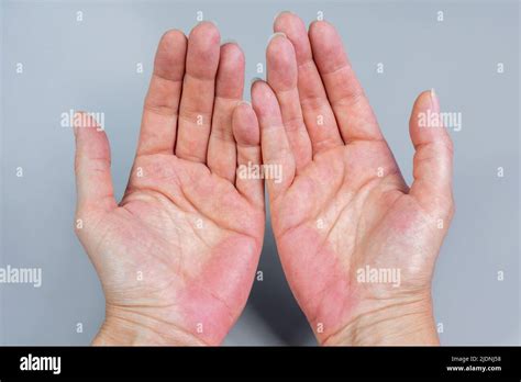 Erythema Hands