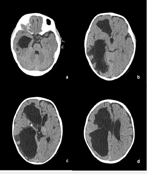 Head Computer Tomography Showing Intraventricular Hemorrhage Download Scientific Diagram