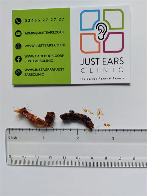 Just Ears Clinic On Linkedin Wax Earwax Earwaxremoval Microsuction