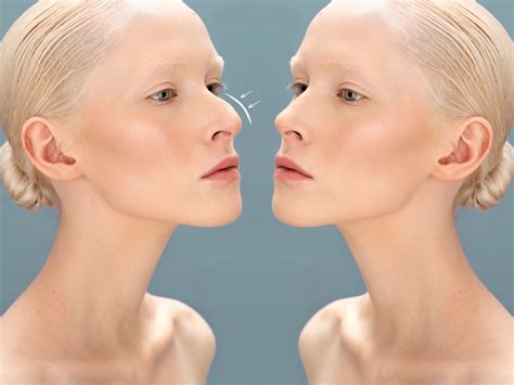 Rhinoplastie Médicale Centre Laser et Esthétique de Bizerte
