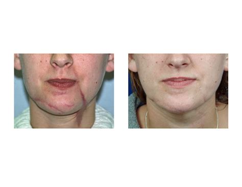 Scar Revision Face Dr Barry Eppley Indianapolis Explore Plastic Surgery