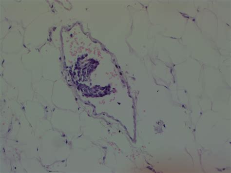 Atlas Of Breast Cancer Early Detection