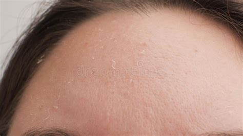 Close Up Forehead Of A Young Woman Of Caucasian Appearance Peeling Of