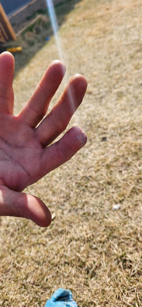 Partial Amputation R Medizzy