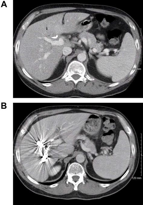 Ct Scan Image Of The Liver A Small Left Lobe Prior To Portal Vein Download Scientific