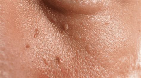 Skin Tags Groin Area